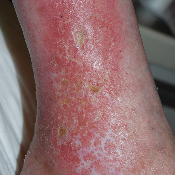 Dermatitis por Estasis - Infodermatitis