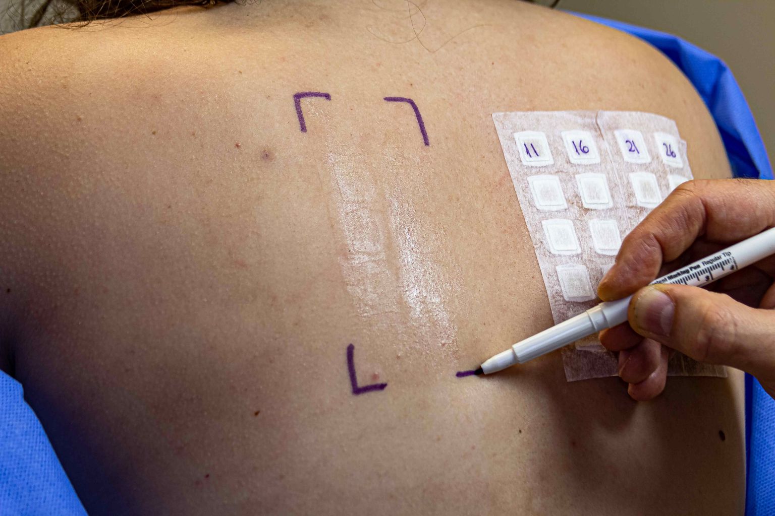 TEST DE PARCHES - Infodermatitis